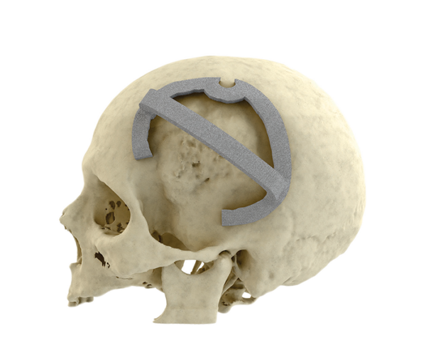 Cranioplasty - MT ORTHO